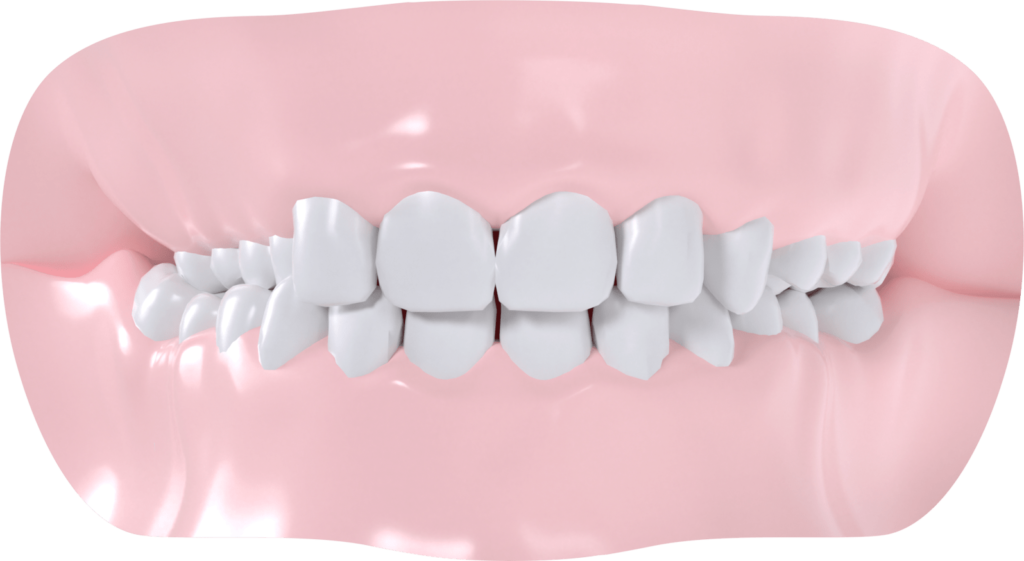 Occlusion croisée droite adolescent - orthodontiste Dentiste