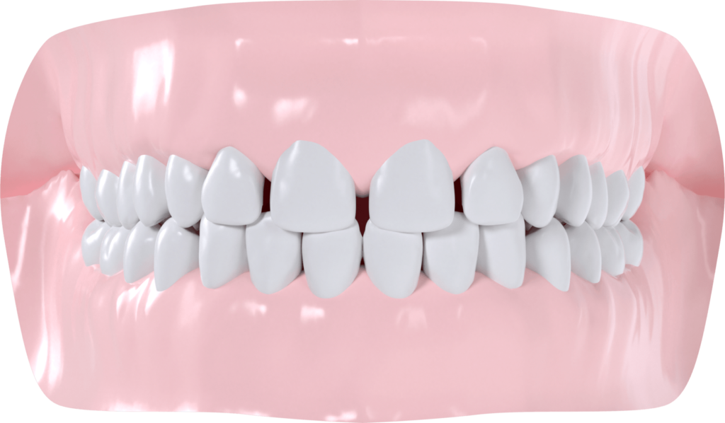 Diastèmes maxillaires adulte - orthodontiste Dentiste